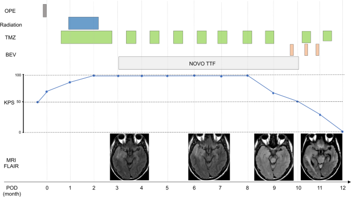 Diffuse midline glioma, H3K27-altered: a rare presentation with ...