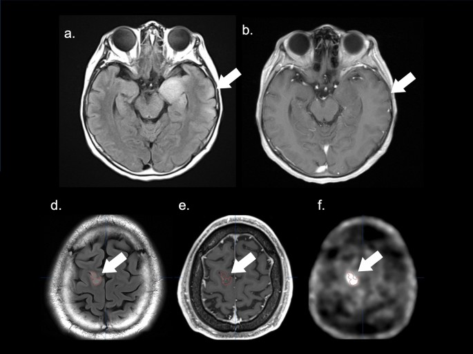 Gyriform infiltration indicates tumor invasion burden of isocitrate ...