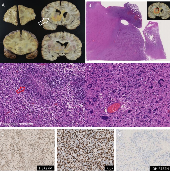 Histologically indolent but widely disseminated diffuse midline glioma ...