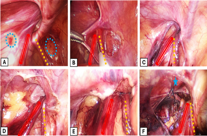 Laparoscopic disconnection of the hernial sac: is it enough for the ...