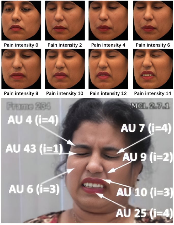 Hierarchical global and local transformer for pain estimation with ...