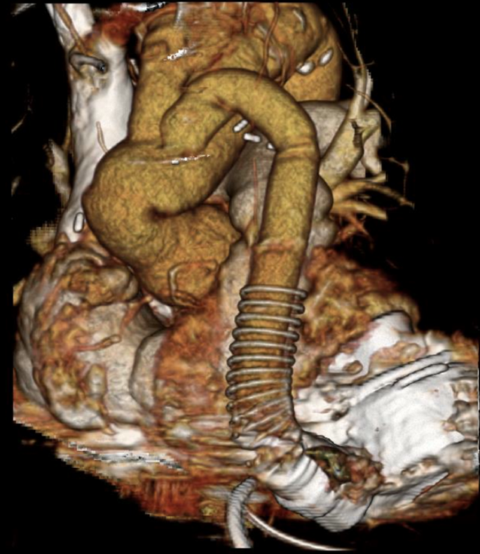 Successful bridge with extracorporeal left ventricular assist device in ...