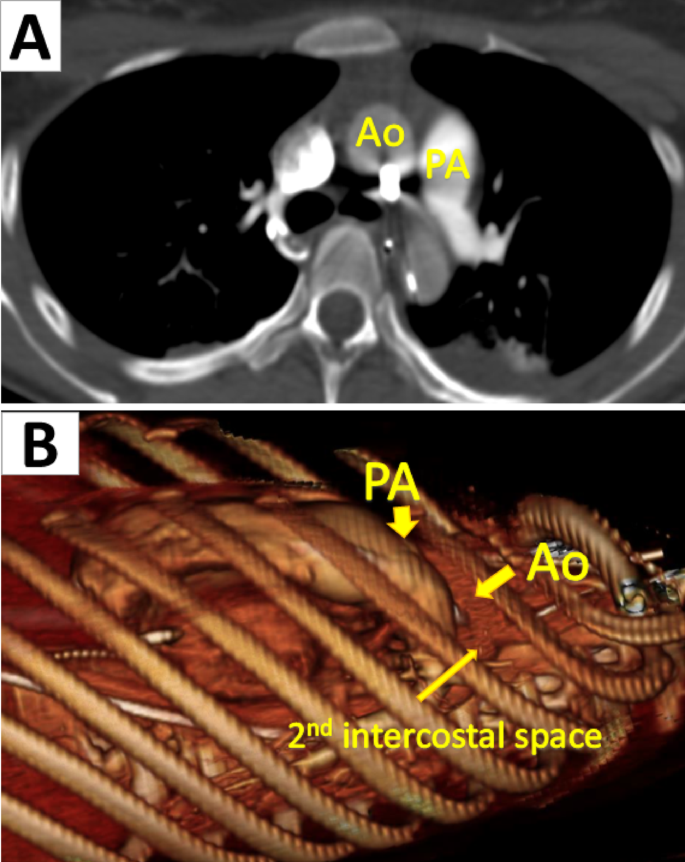 Extracorporeal biventricular support through left mini-thoracotomy ...