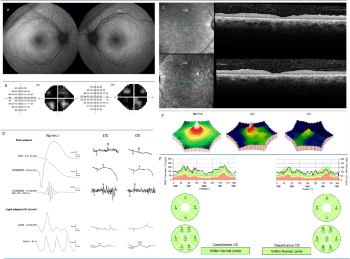 Neuronal ceroid lipofuscinosis 11 (CLN11) presenting with early-onset ...