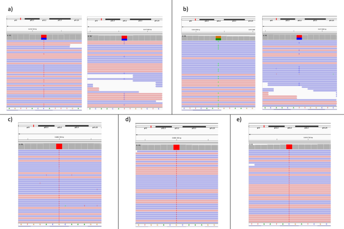 Missense variants in PKAN: insights from a multi-patient genetic ...