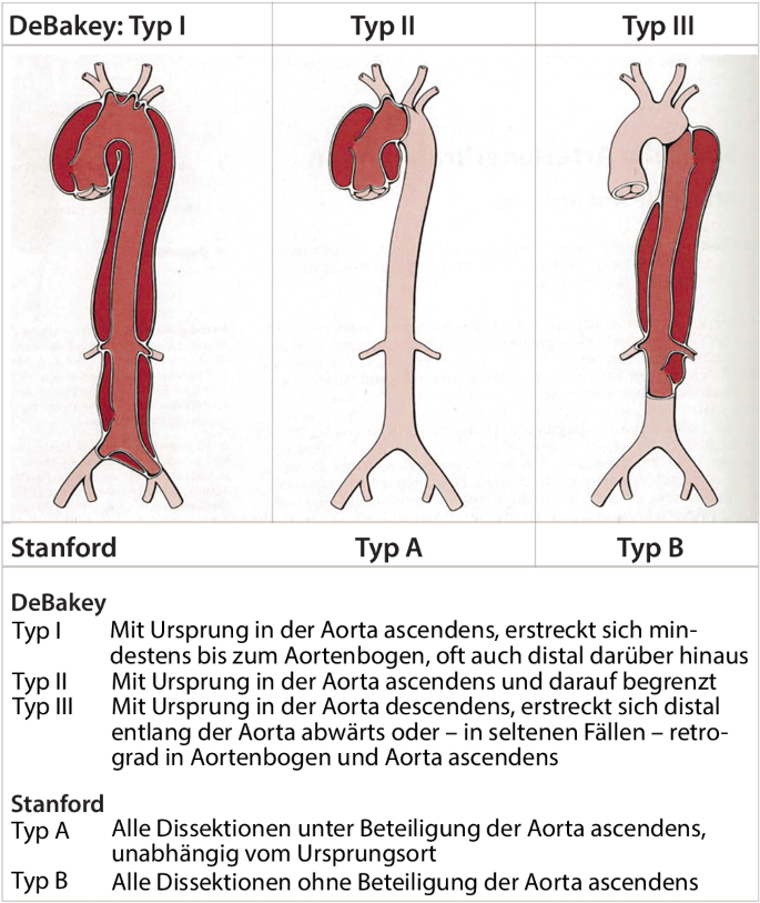 Typ-A-Aortendissektion: Management in der Notaufnahme nach Ablehnung ...