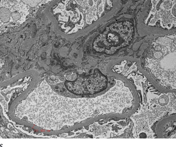 Elevated polyclonal IgG4 mimicking a monoclonal gammopathy in IgG4 ...