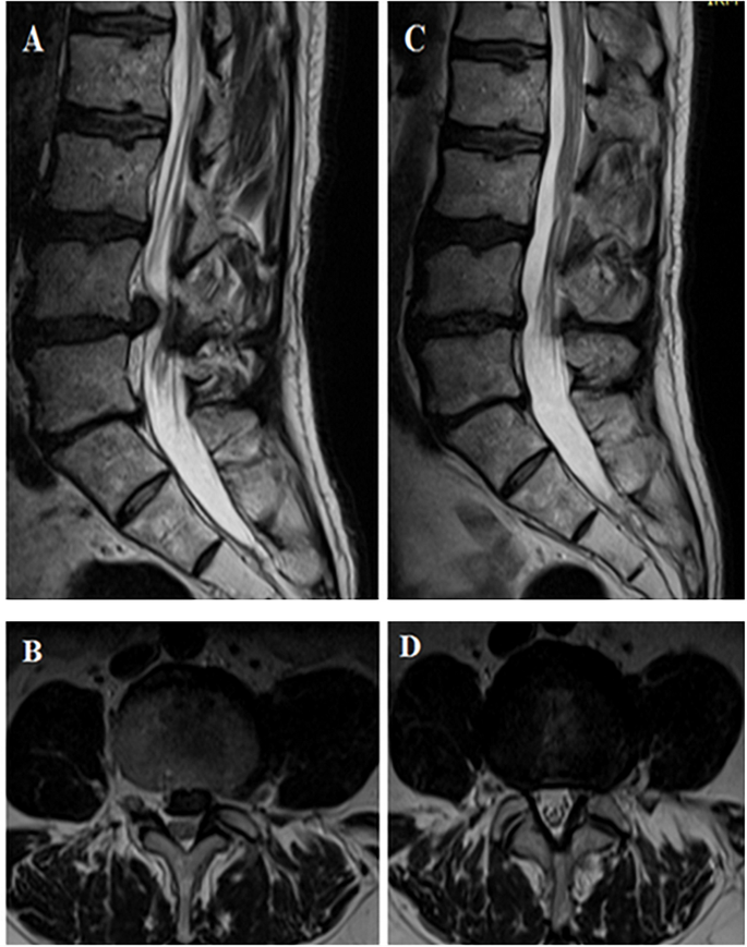 Effectiveness of ozone nucleolysis in alleviating pain and enhancing ...