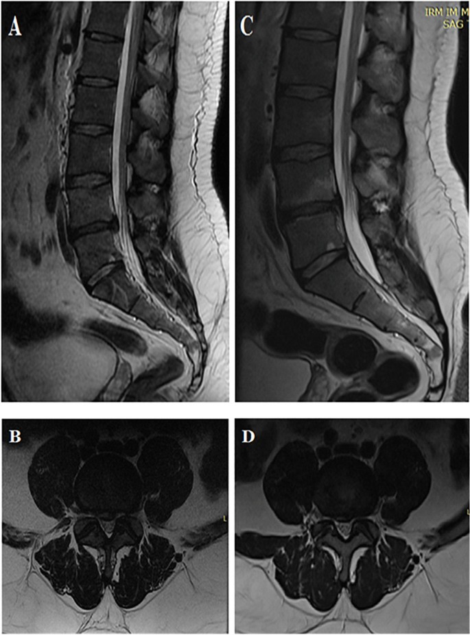 Effectiveness of ozone nucleolysis in alleviating pain and enhancing ...
