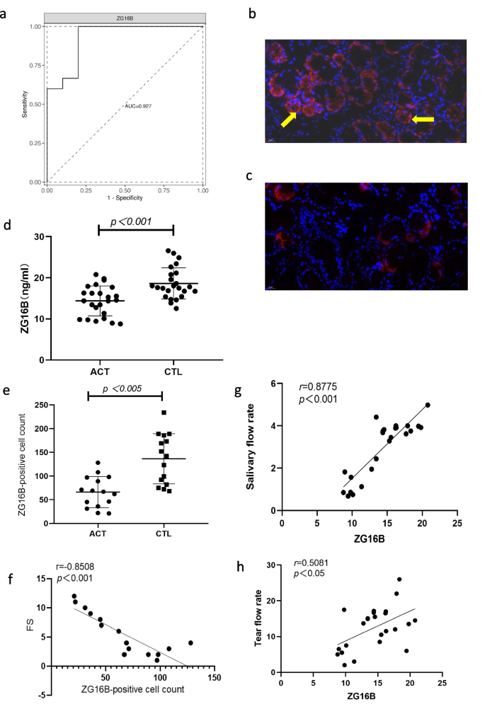 Decreased salivary ZG16B expression is associated with exocrine ...