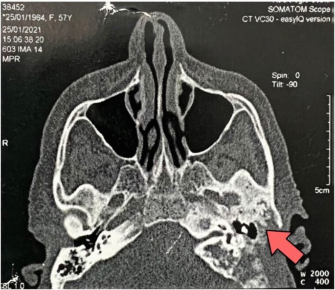 Paget’s disease of bone in a North African population: clinical ...