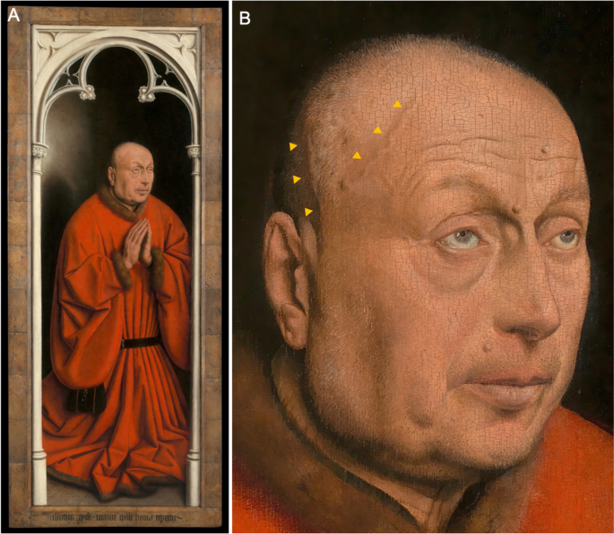 An iconodiagnosis for Joos Vijd, as painted by the van Eycks in the ...