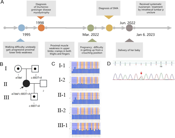 Spinal muscular atrophy caused by compound heterozygous SMN1 mutations ...