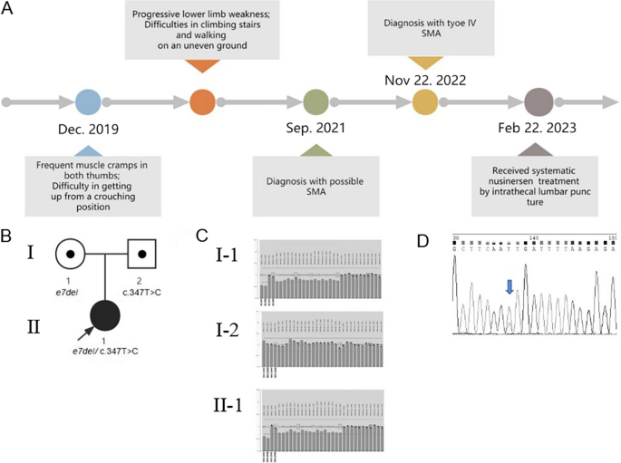 Spinal muscular atrophy caused by compound heterozygous SMN1 mutations ...