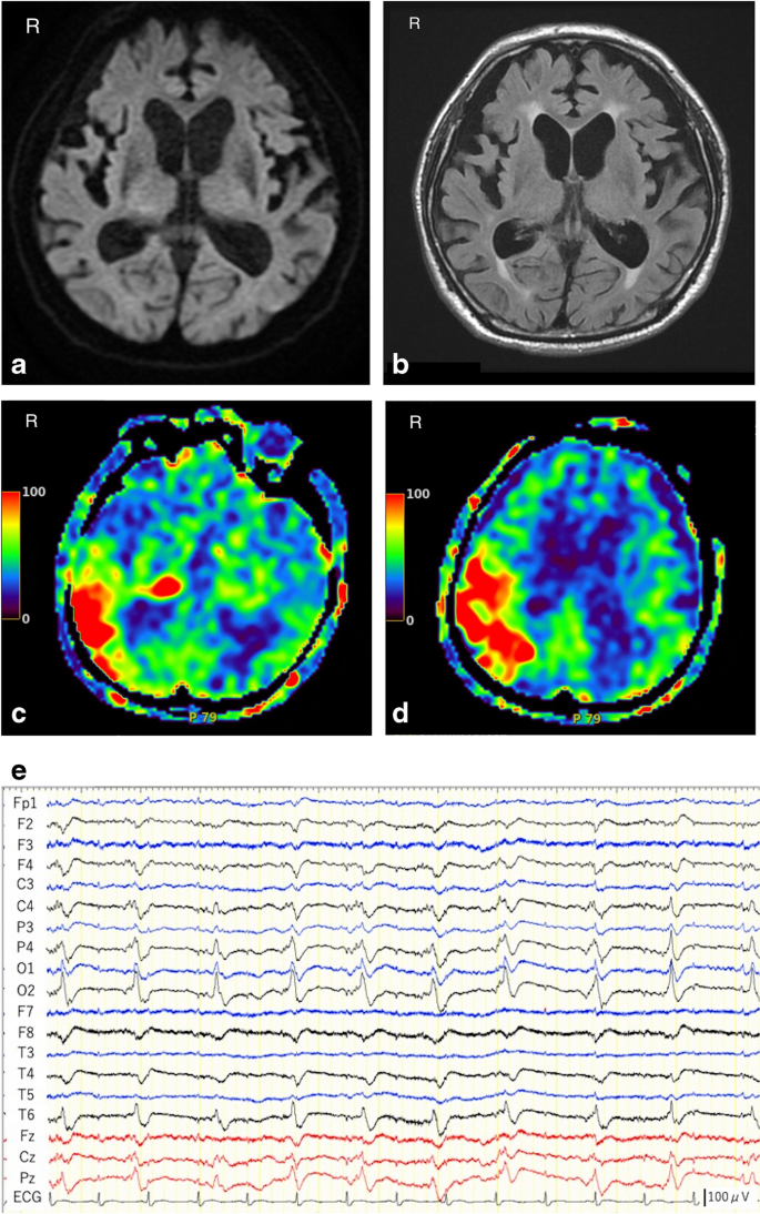 Correlation between lateralized periodic discharges and arterial spin ...