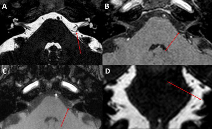 Radiological and intraoperative findings of a rare case of vestibular ...