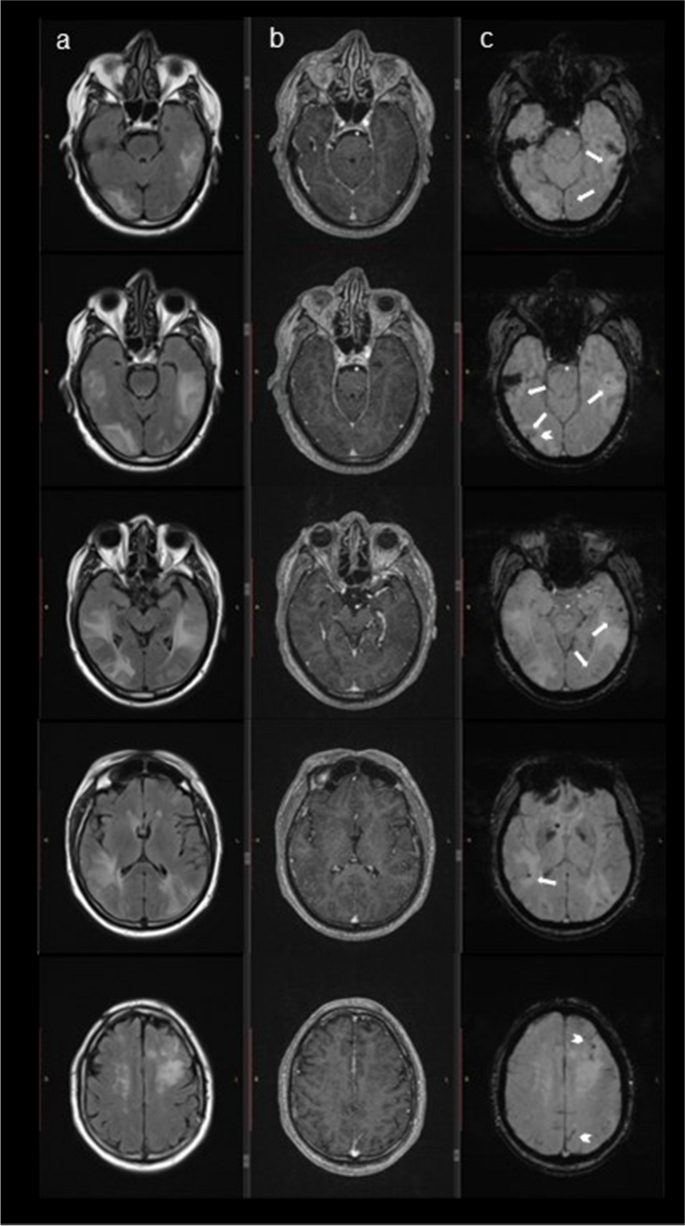Tumefactive cerebral amyloid angiopathy – related inflammation ...