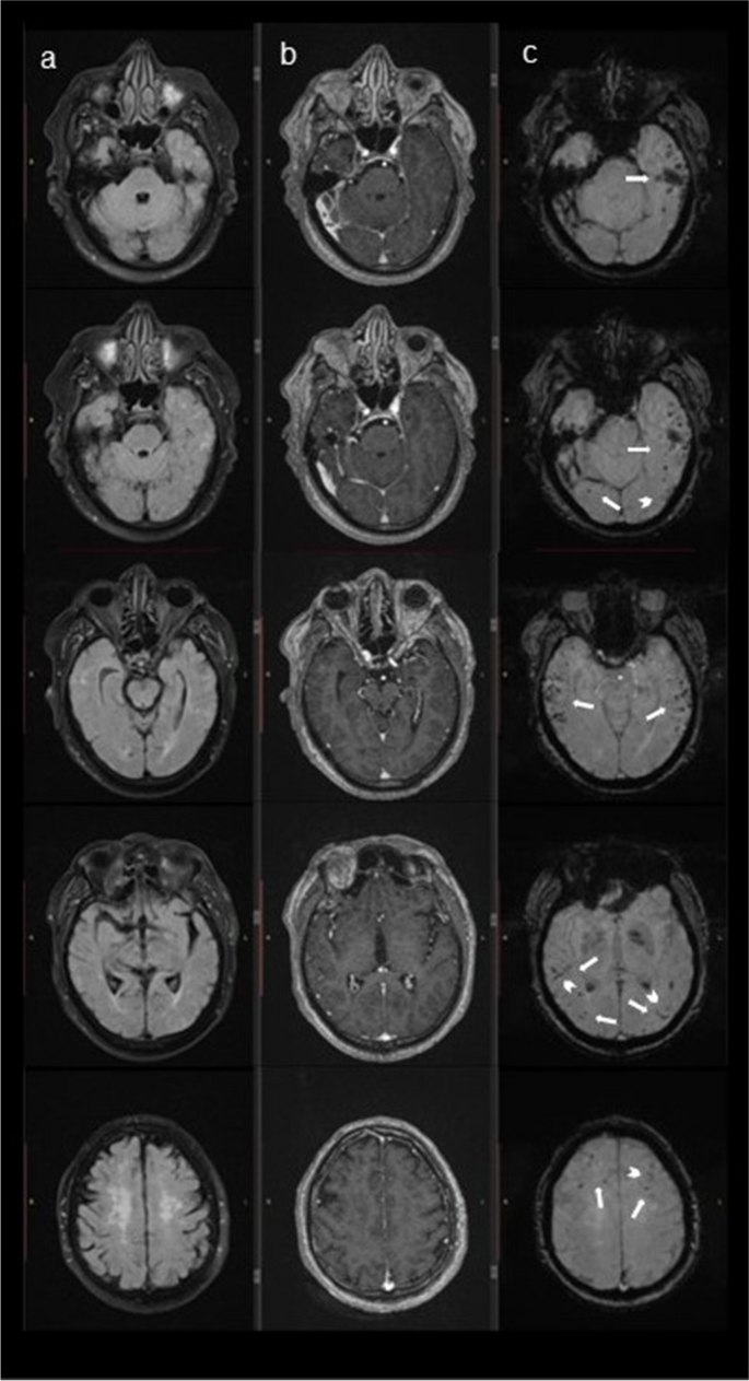 Tumefactive cerebral amyloid angiopathy – related inflammation ...