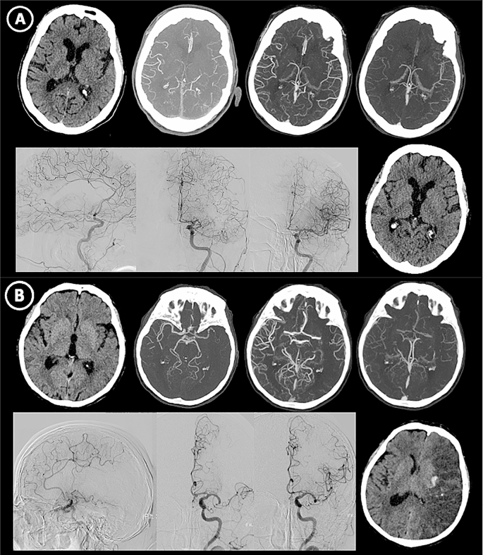 Multi-phase CT-Angiography outperforms angiographic careggi collateral score and predicts ...
