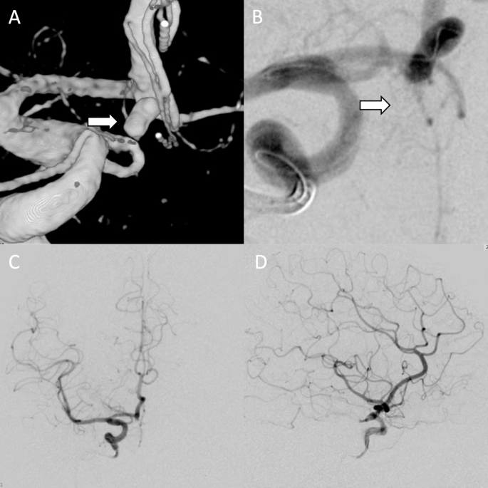 Calcified cerebral emboli following coil embolization: a case report ...