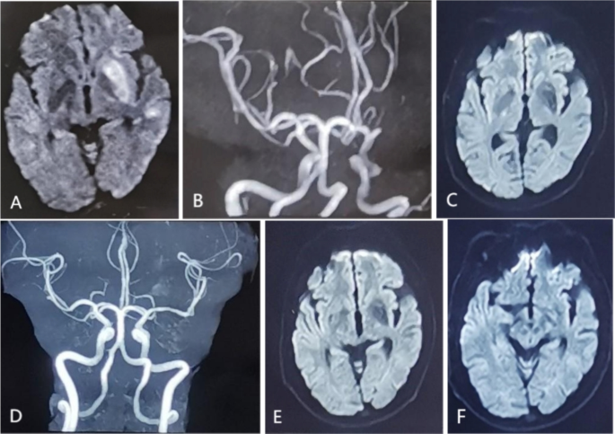 Dystonia during pegylated interferon alpha therapy in a case with ...