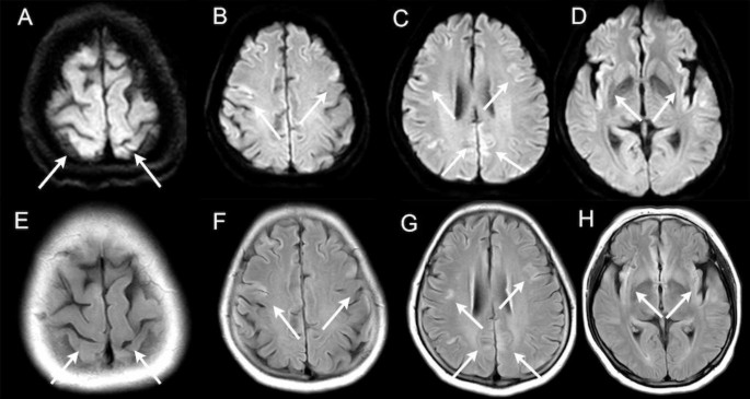 Cortical ribbon sign in AMPAR antibody-associated encephalitis ...