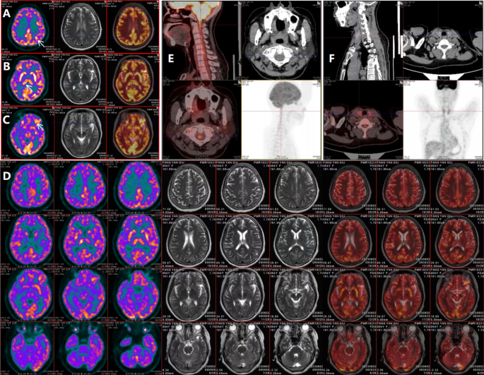A case of 18F-FDG PET/MR facilitates early diagnosis of anti-GFAP ...