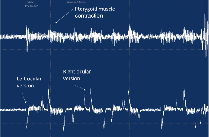 Oculomandibular synkinesia: an underestimated clinical sign ...