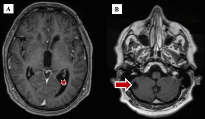 Miliary brain tuberculosis: a rare case report | Neurological Sciences