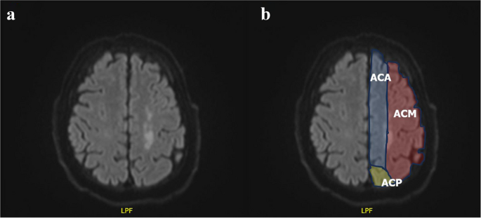 Multimodal imaging reveals intracranial stenosis in a young patient ...