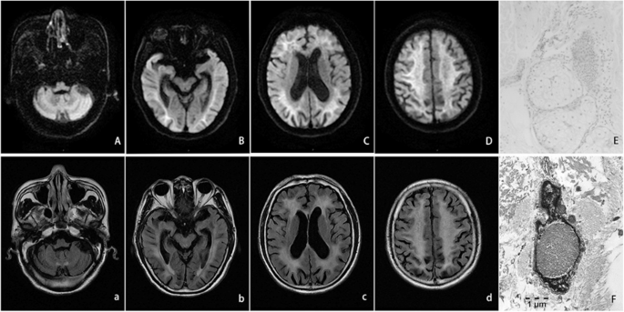 Adult-onset neuronal intranuclear inclusion disease (NIID) combined ...