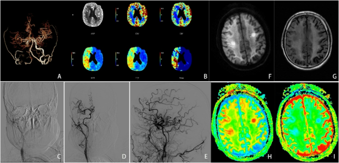 Adult-onset neuronal intranuclear inclusion disease (NIID) combined ...