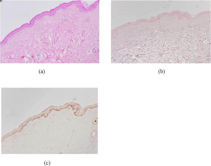 Case Report: Papillary Dermal Elastolysis in a Patient Receiving ...