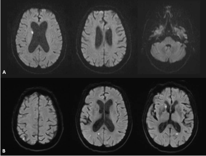 Multiple calcific embolism – a rare cause of embolic ischemic stroke ...