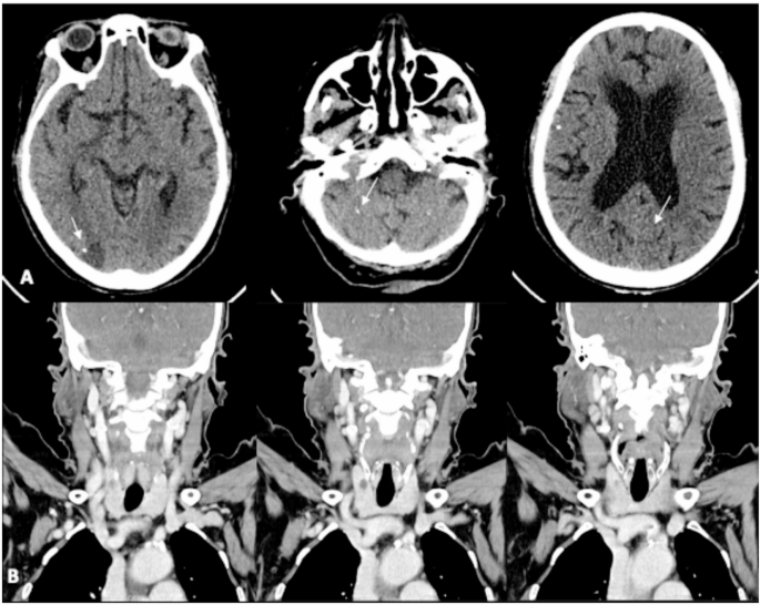 Multiple calcific embolism – a rare cause of embolic ischemic stroke ...