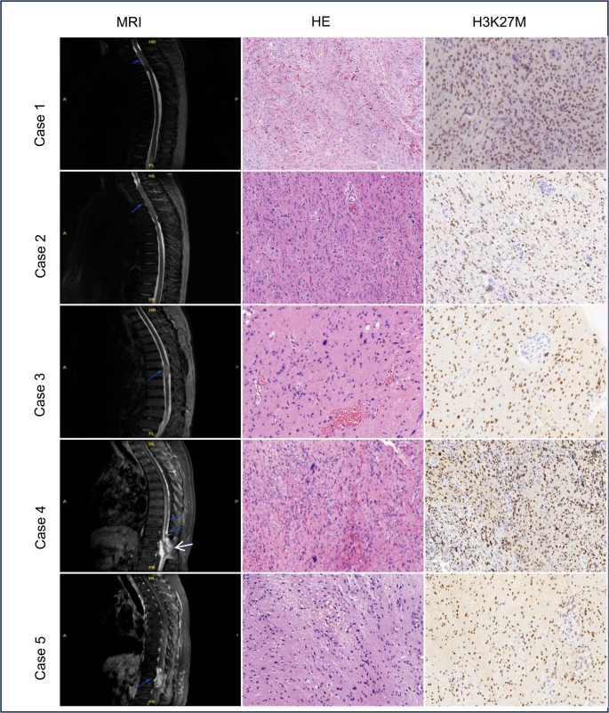 Adult spinal cord diffuse midline gliomas with piloid features have a ...