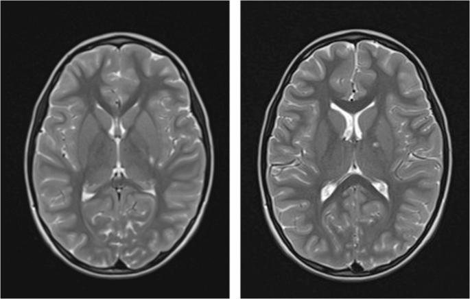 Hemichorea as a primary manifestation of varicella-zoster virus ...