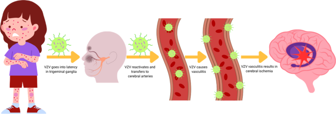Hemichorea as a primary manifestation of varicella-zoster virus ...