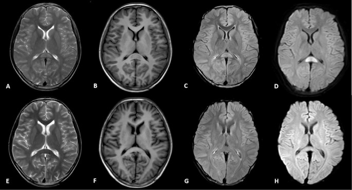 Some novel causes and clinical characteristics of reversible splenial ...