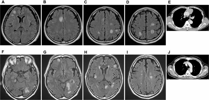 Characteristic MRI findings in GABAA receptor encephalitis with thymoma ...