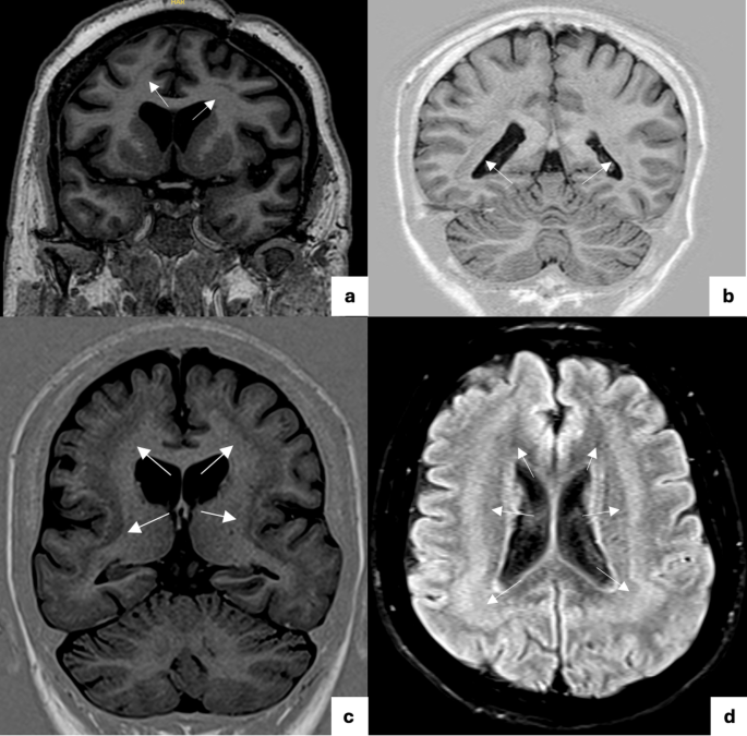 Subcortical band heterotopia: electroclinical, radiological, and ...
