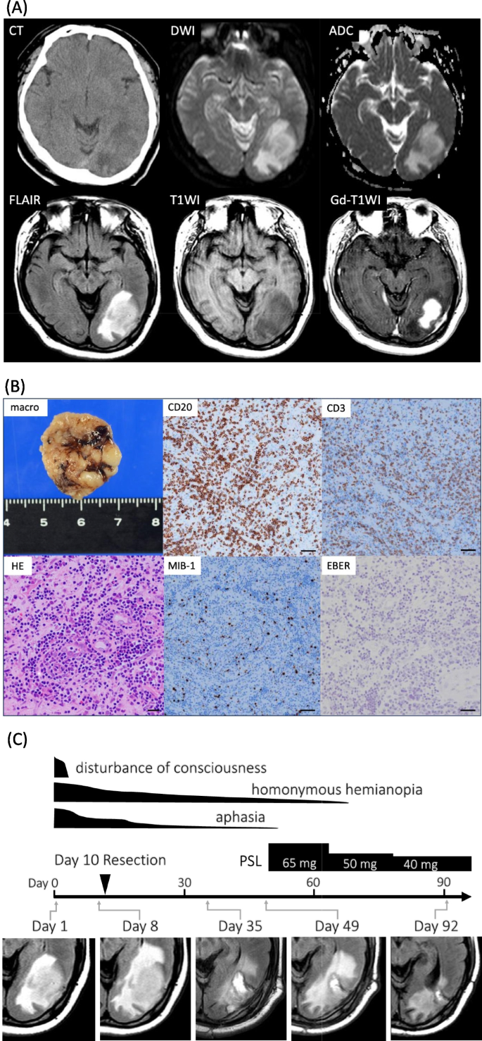EBV-negative, CNS-restricted iatrogenic lymphoproliferative disorder ...
