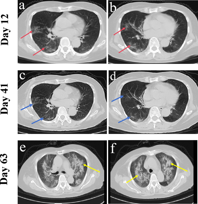 Pulmonary microbial spectrum in late-stage SARS-CoV-2 infection: a case ...