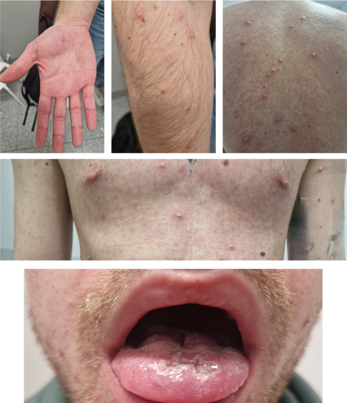 An atypical case of infection with the Mpox virus clade IIb lineage C.1 ...