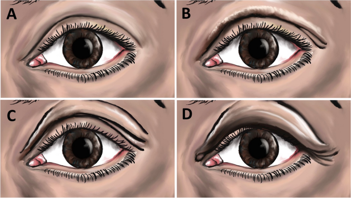 Ablative radiofrequency microplasma for lateral dermatochalasis ...