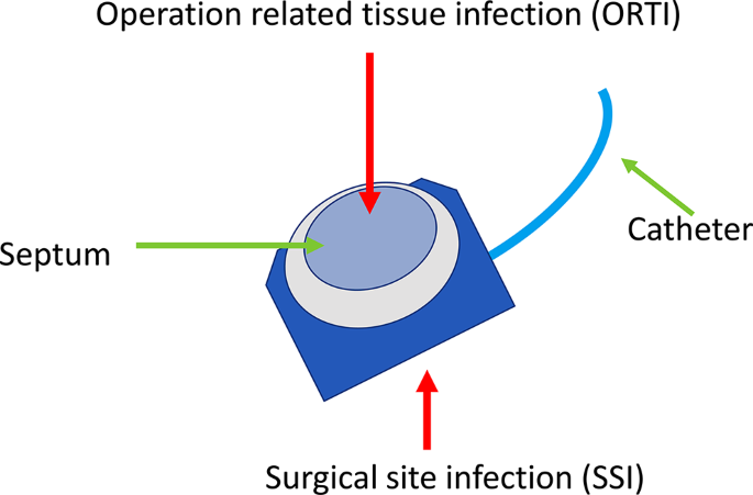 Development of bacteriostatic central venous port using ...