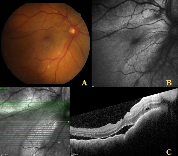 Optical coherence tomography and fundus autofluorescence features in ...
