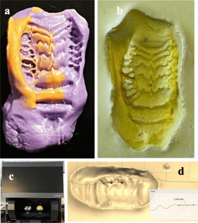 Effect of photobiological regulation of green laser on orthodontic ...