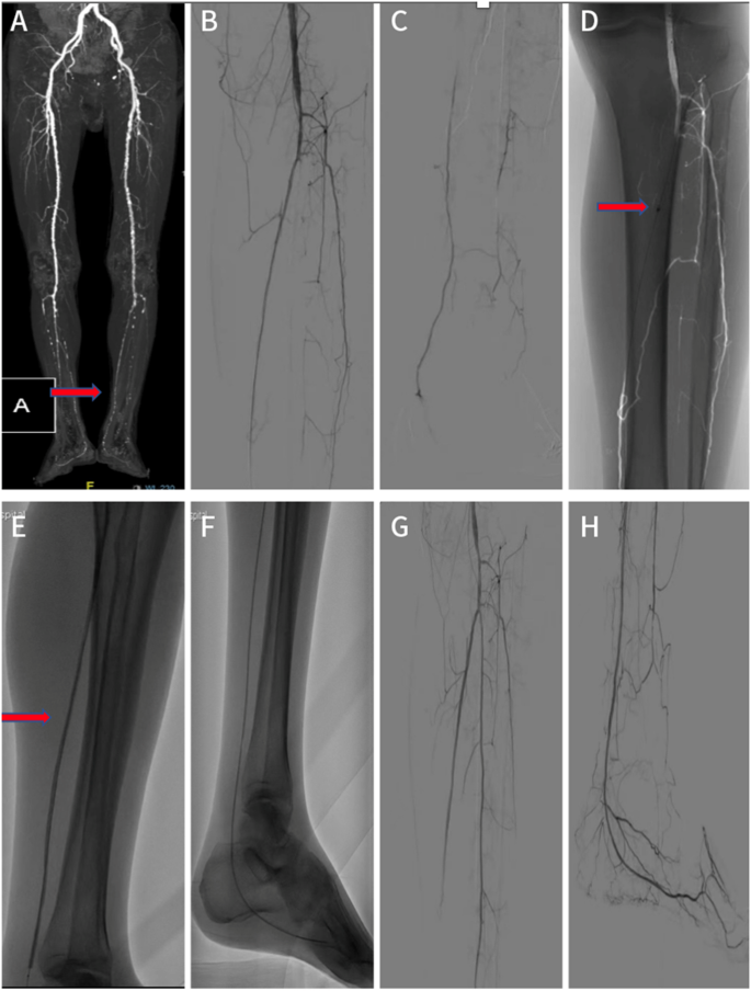 Efficacy and safety of excimer laser atherectomy plus drug-coated ...
