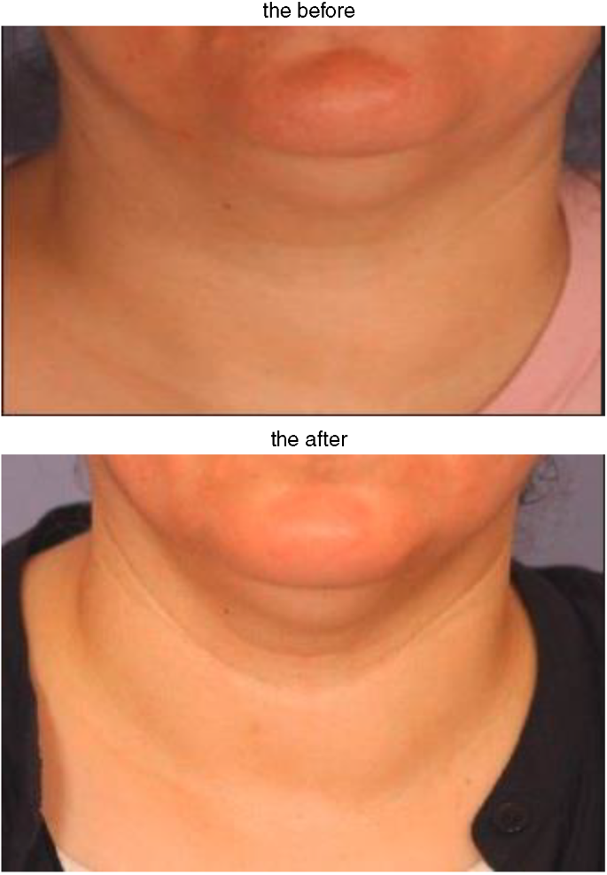 Safety and efficacy of 1550-nm Non-Ablative fractional laser for neck ...